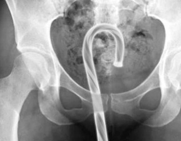 Very Unusual Objects Stuck Inside Peoples Orifices That Required Er Visits Have Been Revealed