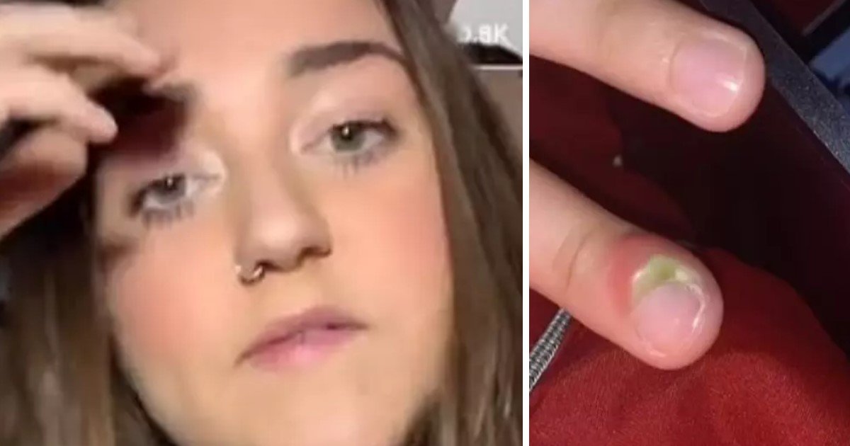 A Teens Nail Biting Habit Almost Led Her To Get Her Finger Amputated