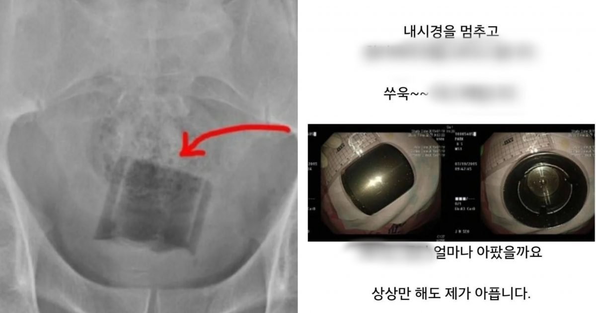 항문에 도대체 뭘 넣은 거라고”항문에 자꾸 뭘 넣는 응급 환자들때문에 고통받는 응급실 의사들 Newsnack